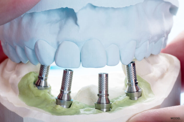 Full Arch Dental Implant Aftercare